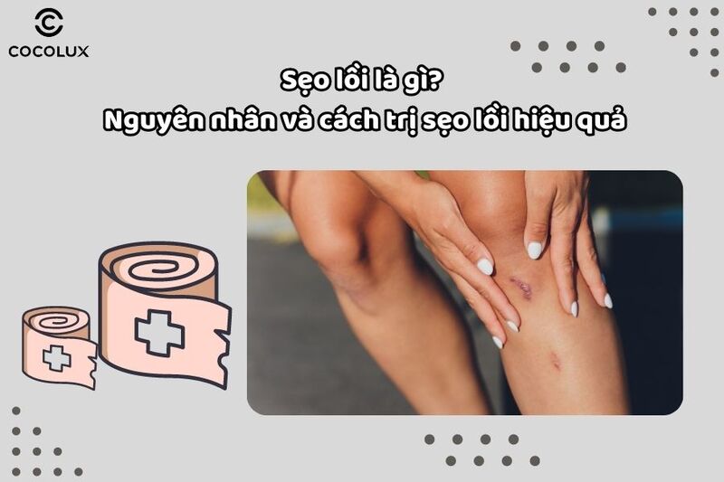 Sẹo lồi là gì? Nguyên nhân và cách trị sẹo lồi hiệu quả